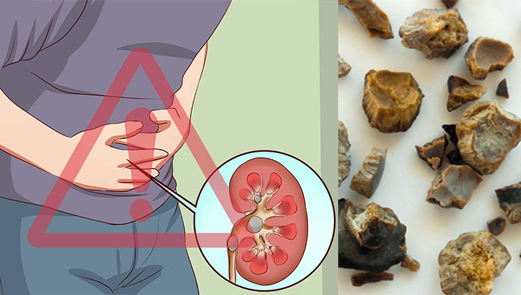 Gurët në veshka, mjekja e njohur bën publike informacionet që duhet t’i ...