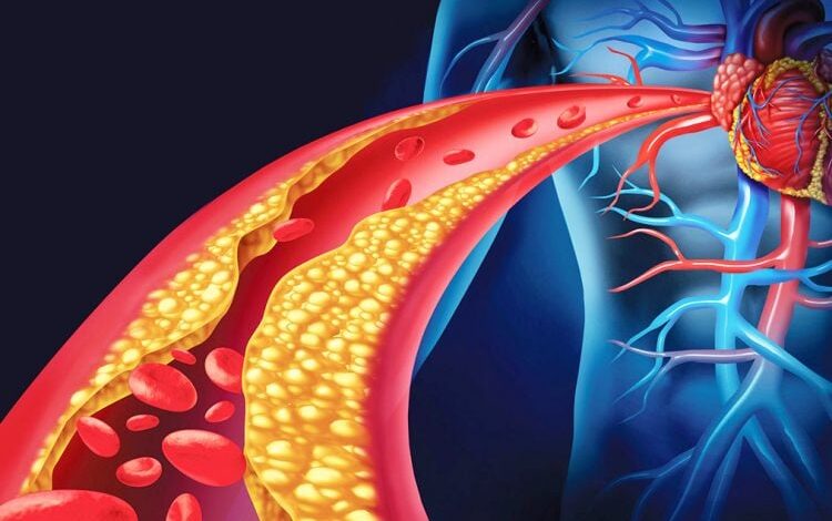 "Tumoret e lëkurës"/ Simptoma kryesore e kolesterolit të lartë të cilën ...