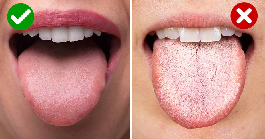 Pse ju bëhet gjuha e bardhë dhe çfarë do të thotë për shëndetin tuaj ...