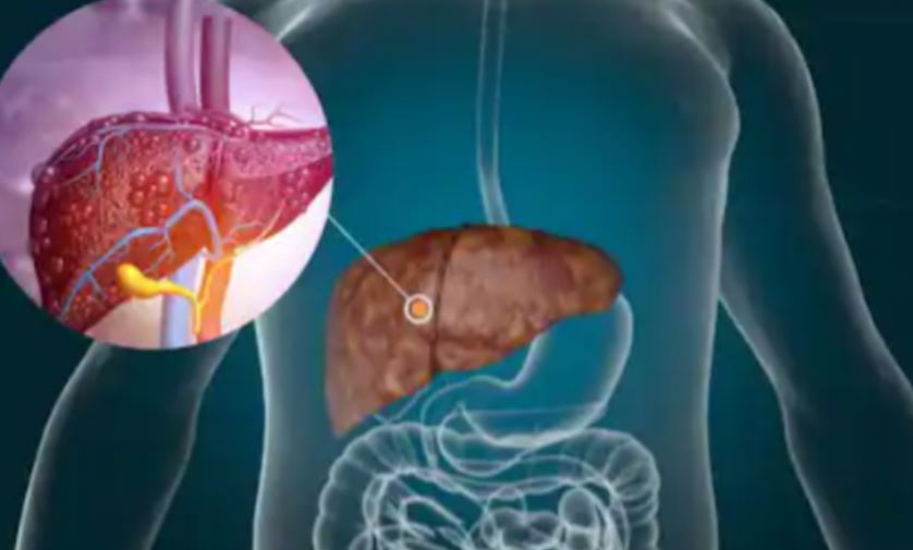 Zbuloni cilat janë simptomat e mëlçisë së dhjamosur - Sot News | Lajme