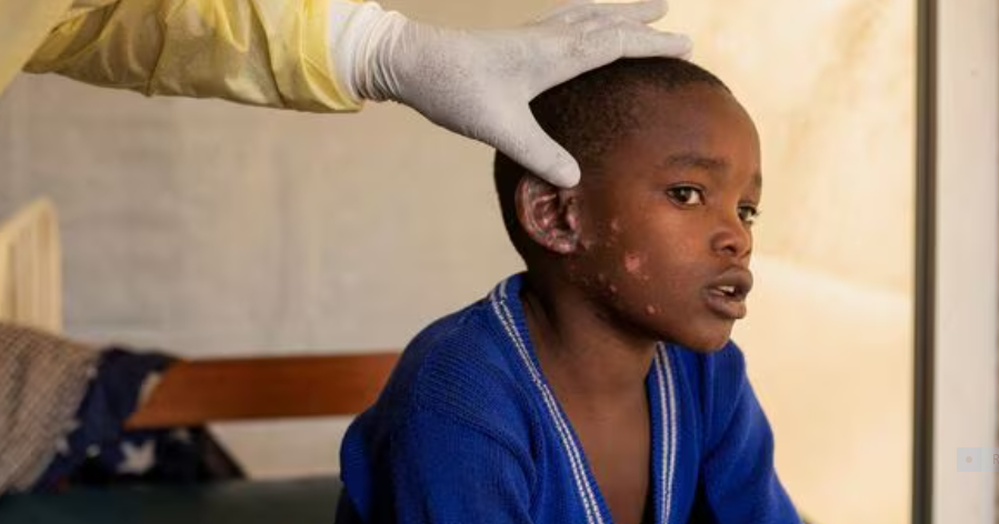 Ethet deri në dhimbje koke, njihni simptomat e mpox, ja çfarë duhet të ...